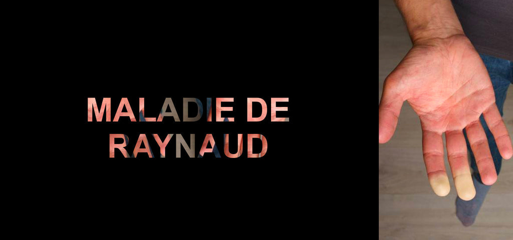 Qu’est-ce que la maladie de Raynaud ? – Climb Winter